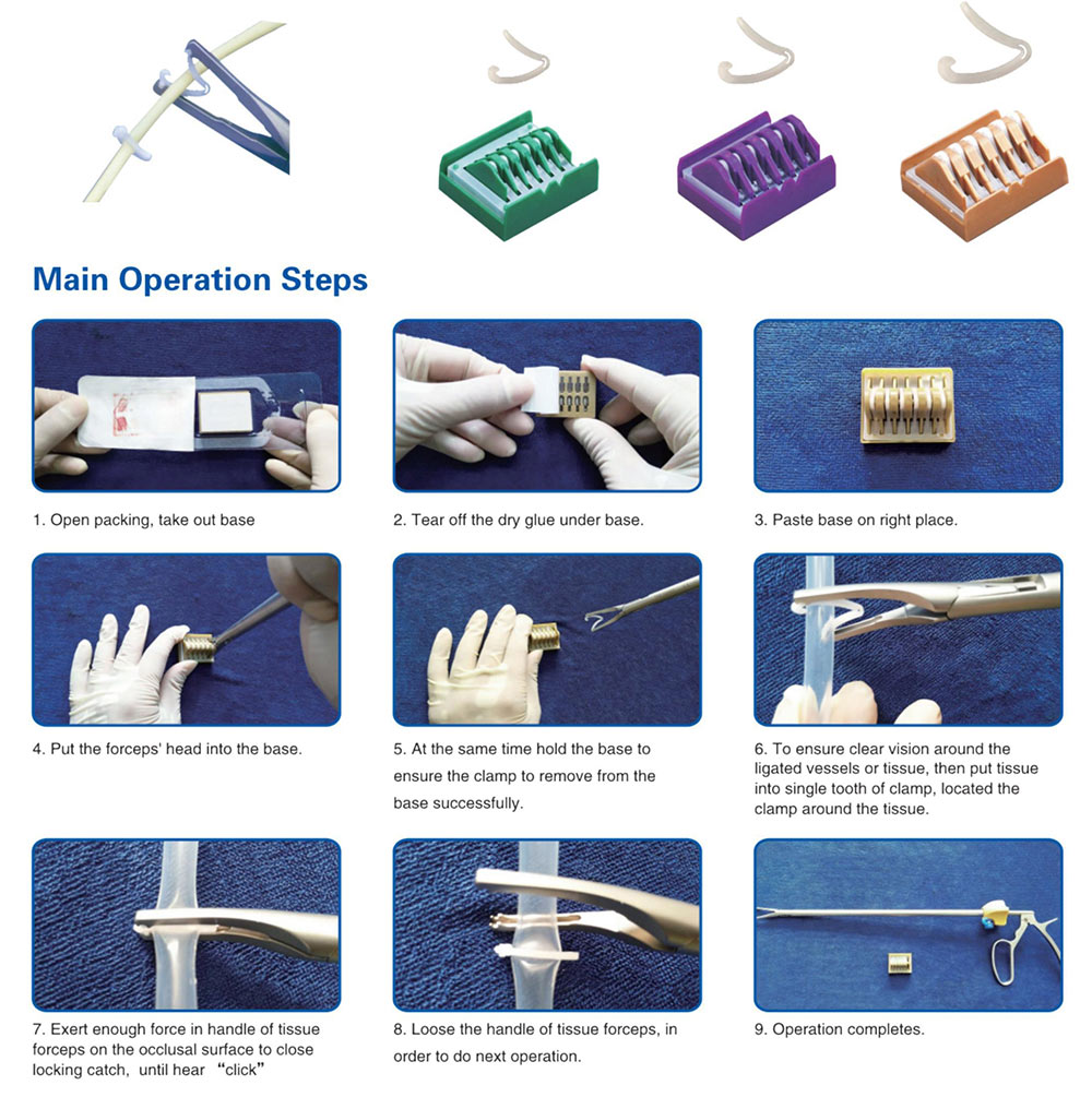 Disposable Ligating Clips - New Product - Endoscopic Stapler,Open ...